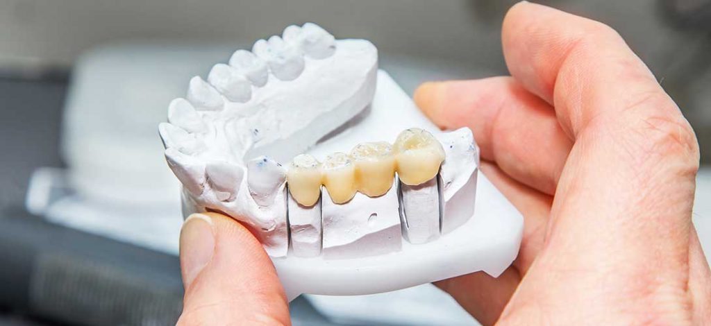 Missing teeth? The most successful tooth replacement options in India ...