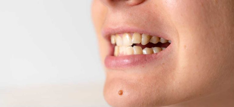 Crowded Teeth Causes & Treatment in India - Stunning Dentistry Blog
