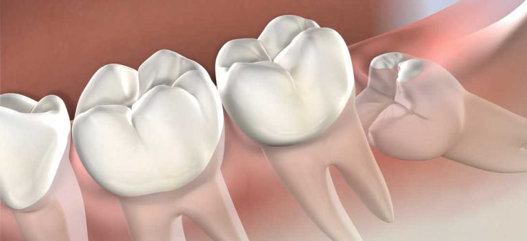 Early Warning Signs of an Impacted Wisdom Tooth - Stunning Dentistry Blog